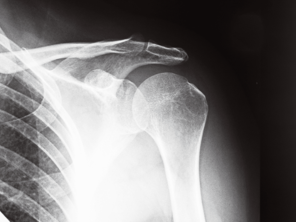 Shoulder Fracture Treatment - Austin, Texas - Dr. Szerlip